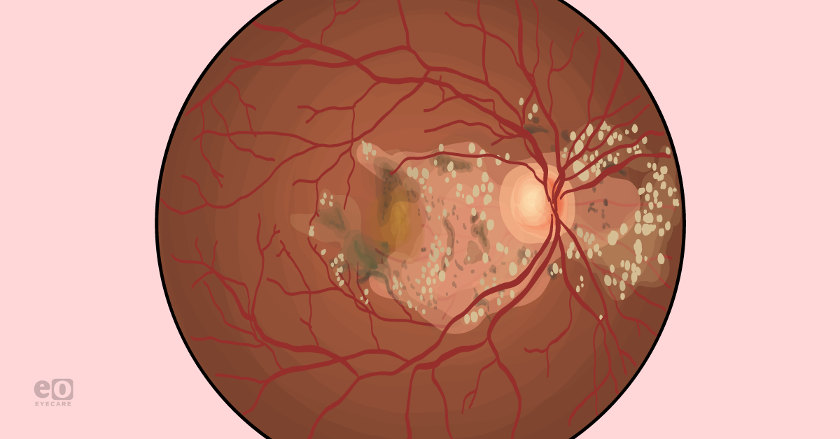 The Ophthalmology Resident's Guide to Inherited Macular Dystrophies ...