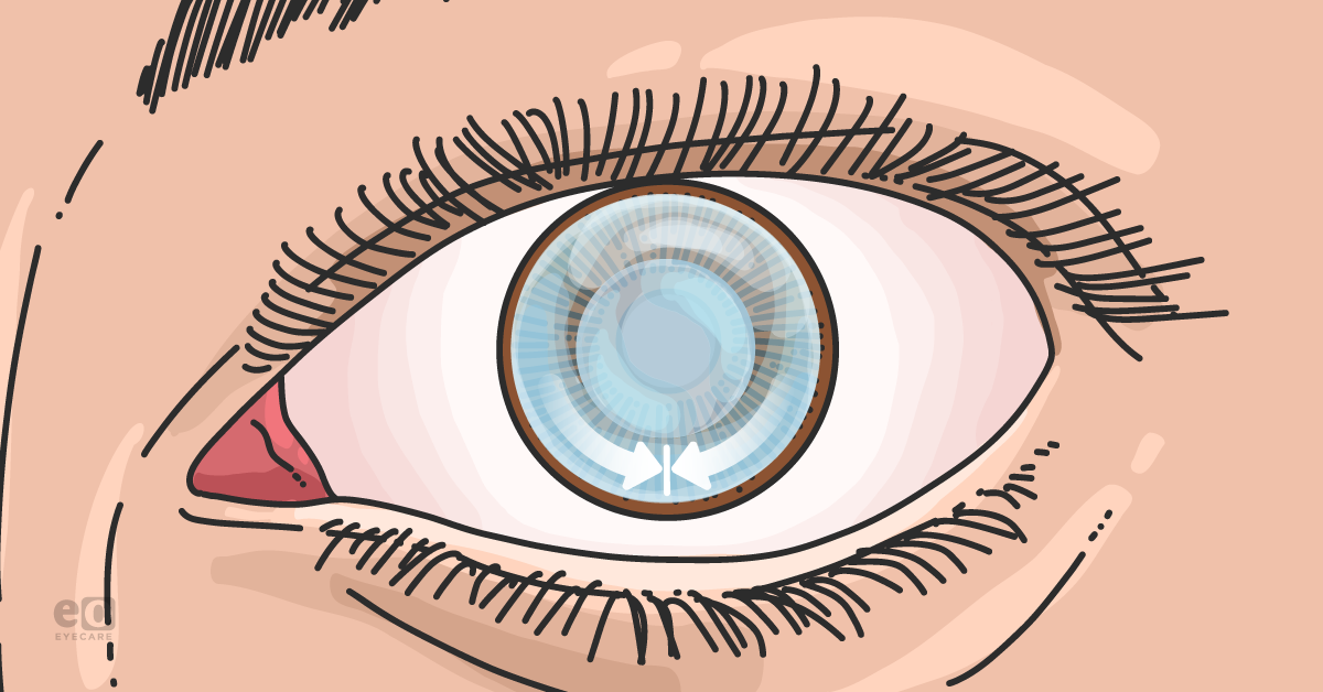 The Ultimate Guide to CooperVision Toric Lenses