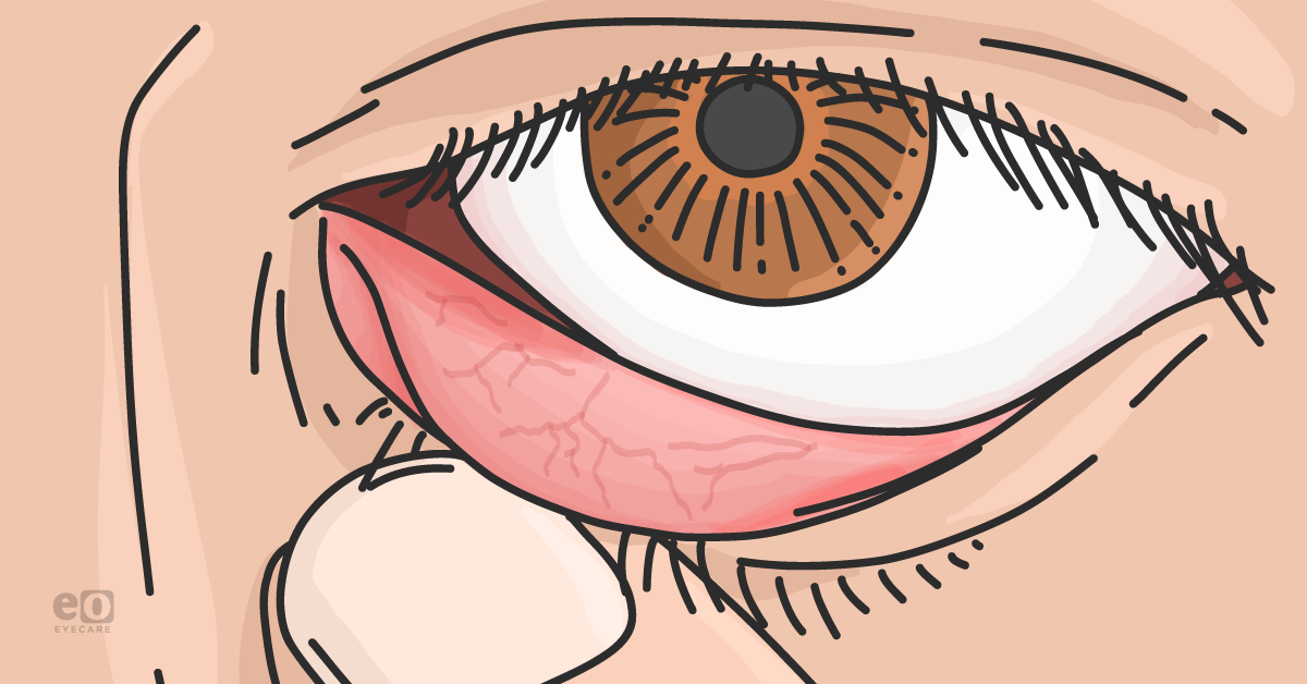 The Continuously Evolving Story of MGD and Dry Eye