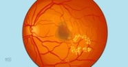 Pseudophakic Cystoid Macular Edema What To Do And When To Refer