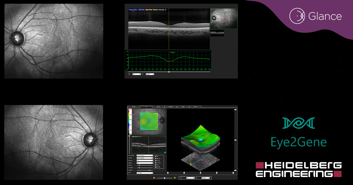 Heidelberg and Eye2Gene partner on AI ophthalmic diagnostics for IRD