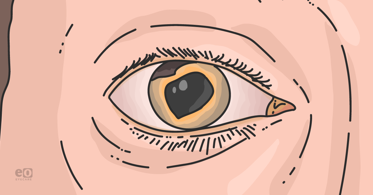 The Many Faces of Traumatic Glaucoma