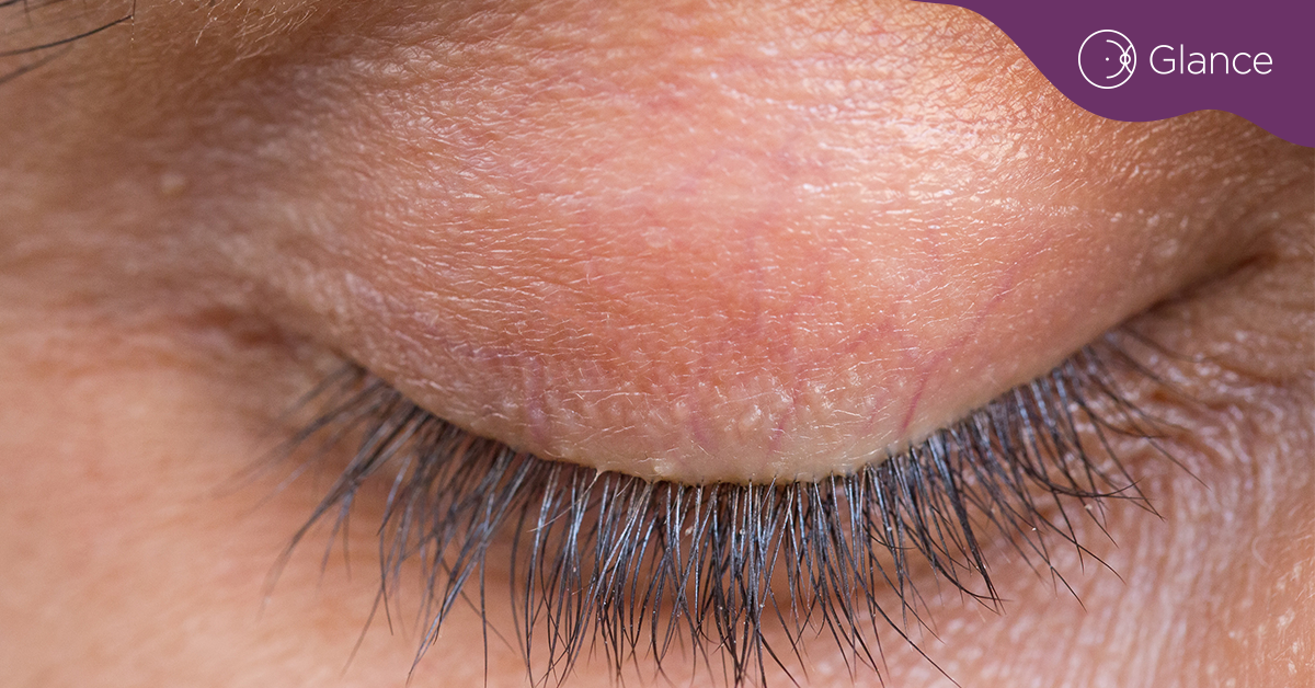 Topical ivermectin exhibits positive safety profile for Demodex blepharitis