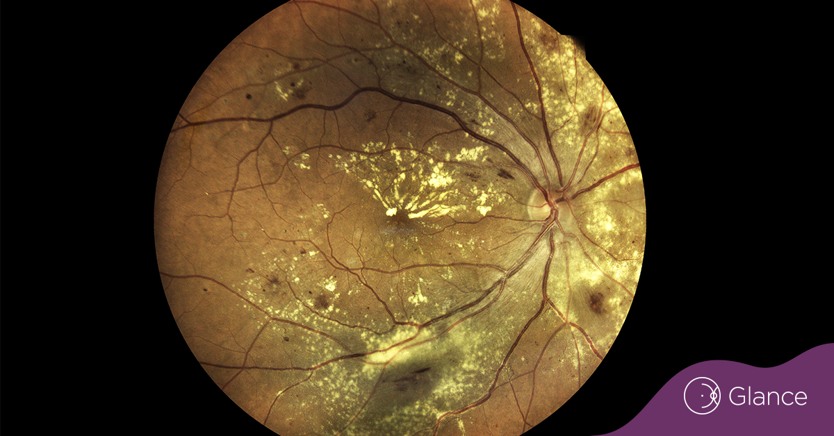 Night vision tests may help with AMD prevention, treatment