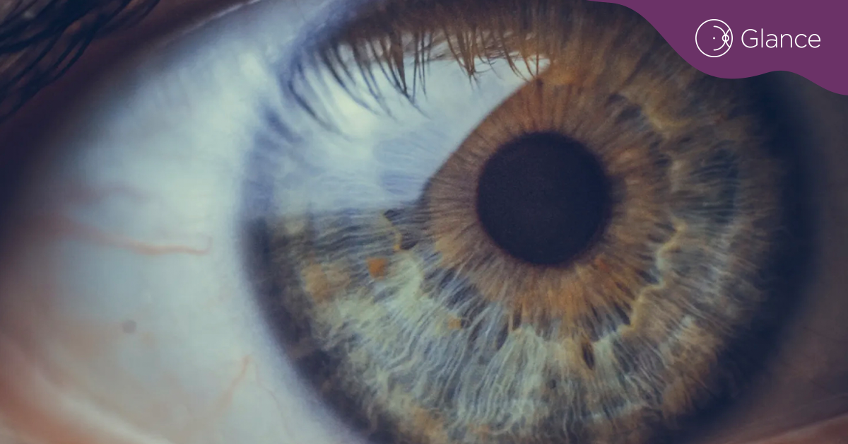 Researchers detect first dry eye-specific genetic locus