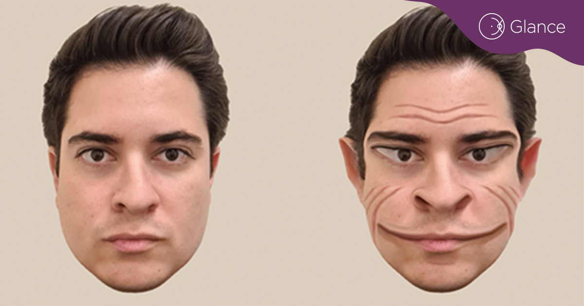 Study details rare visual condition of facial distortion