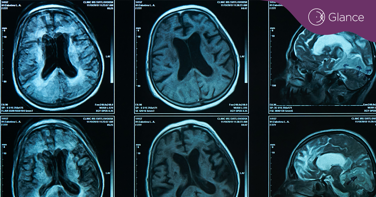 Why do patients with congenital blindness show visual processing ...