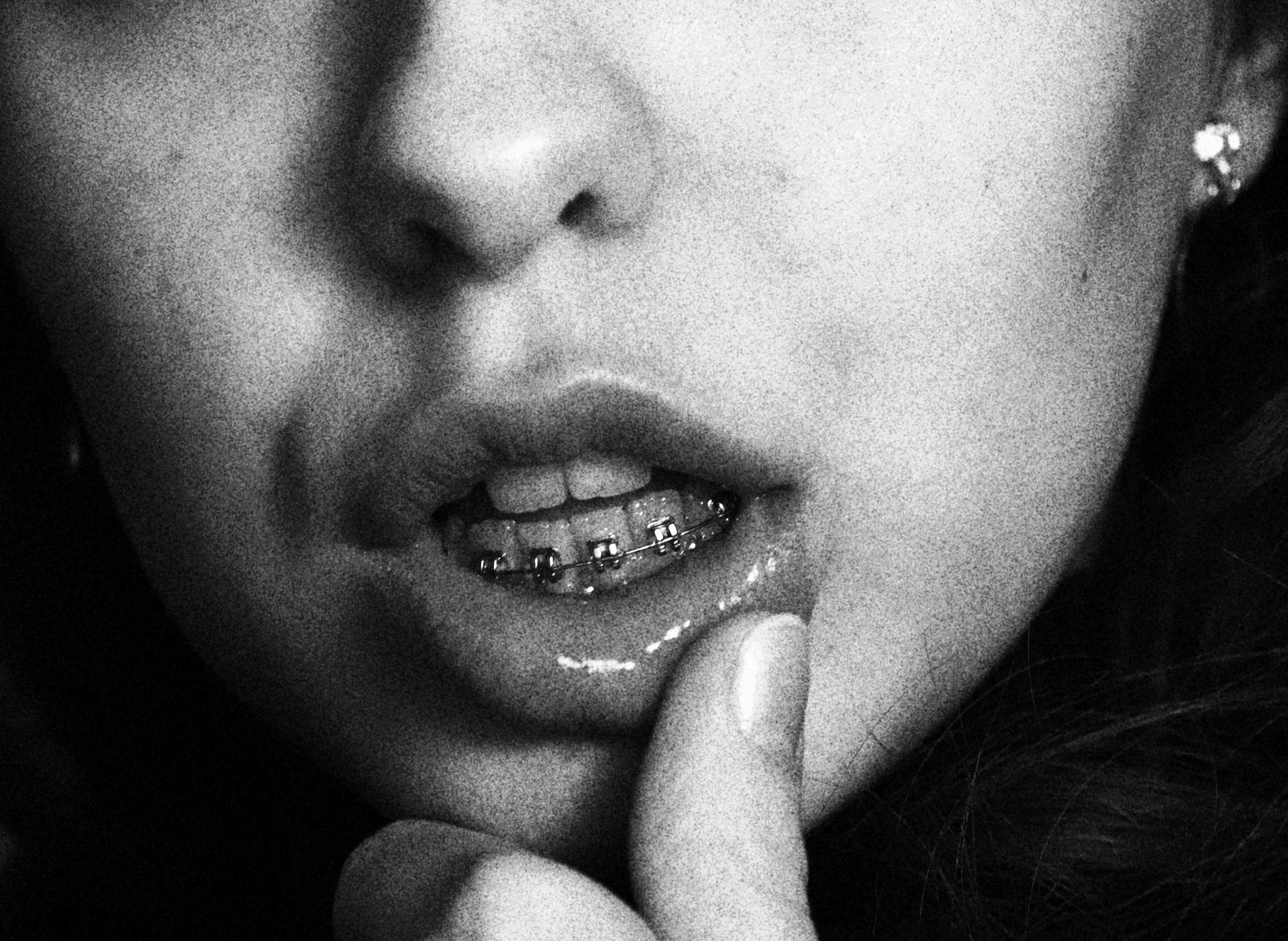 Broken Braces? What To Do if a Bracket or Wire Breaks | Windmill ...