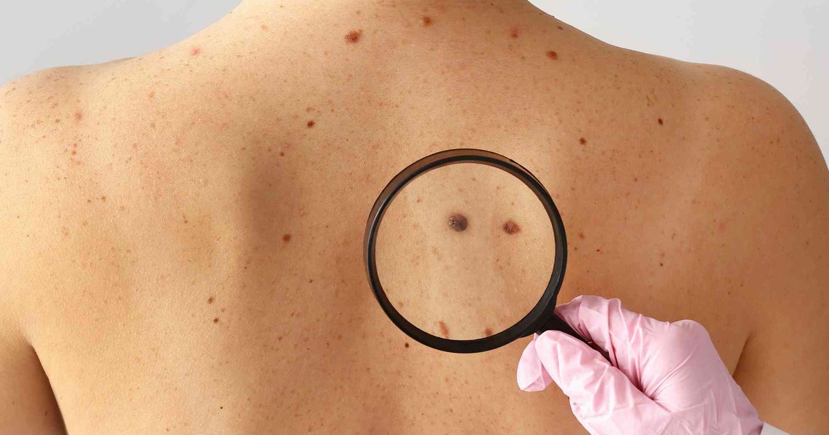 Dr.Dropin | Hudkreftklinikken - Spesialister i hudkreft og behandling