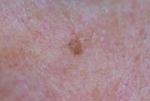Dr.Dropin | Actinic keratosis - Fast and effective treatment - Dr.Dropin
