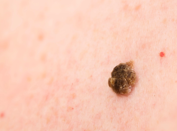 Dr.Dropin | Sebaceous warts (Seborrheic keratosis) - Removal