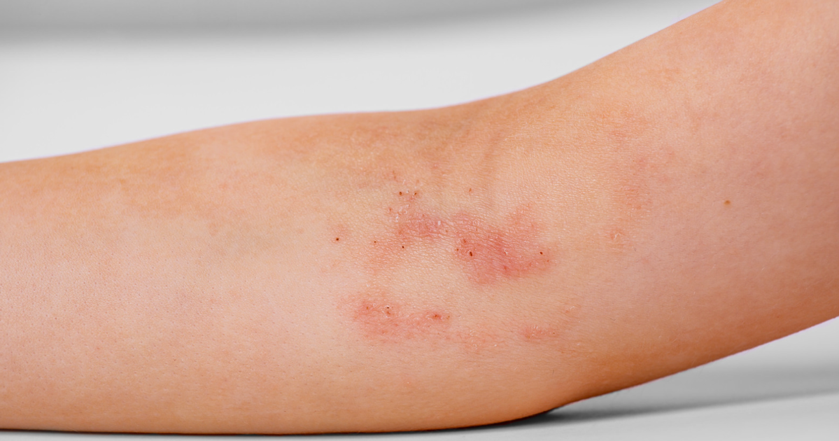 Dr.Dropin | Eksem og hudplager | Symptomer og behandling | Dr. Dropin