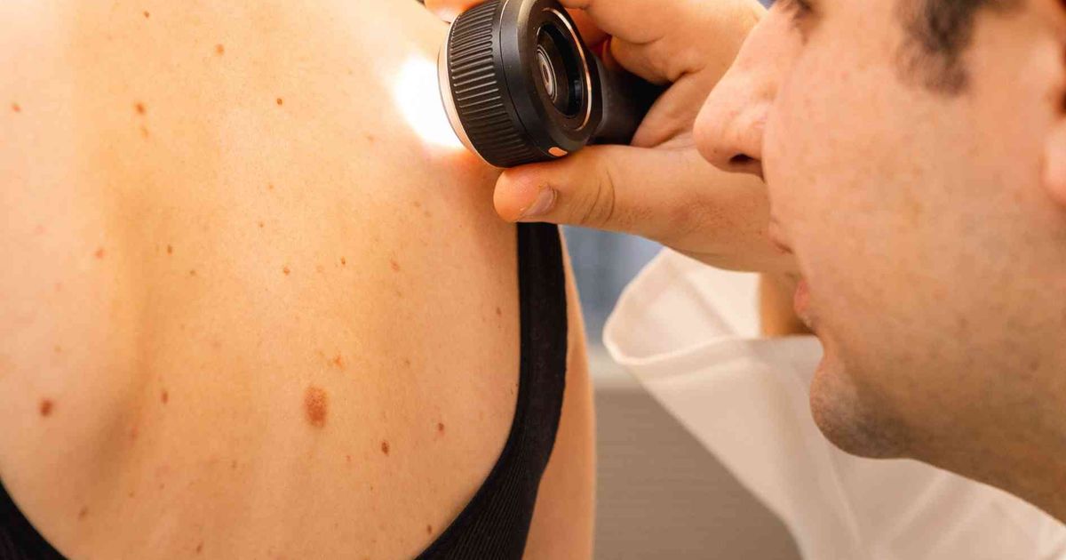 Dr.Dropin | Moles | Check, removal, screening