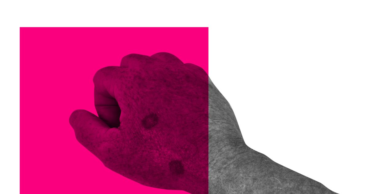 Why Some Parts of India Have Higher Rates of Skin Cancer: Study | The ...