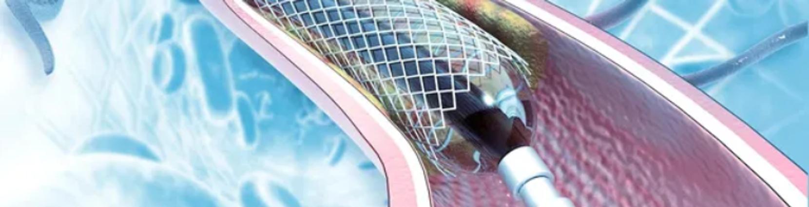 Angioplastia em Pacientes Submetidos à Implante de Prótese Aórtica ...