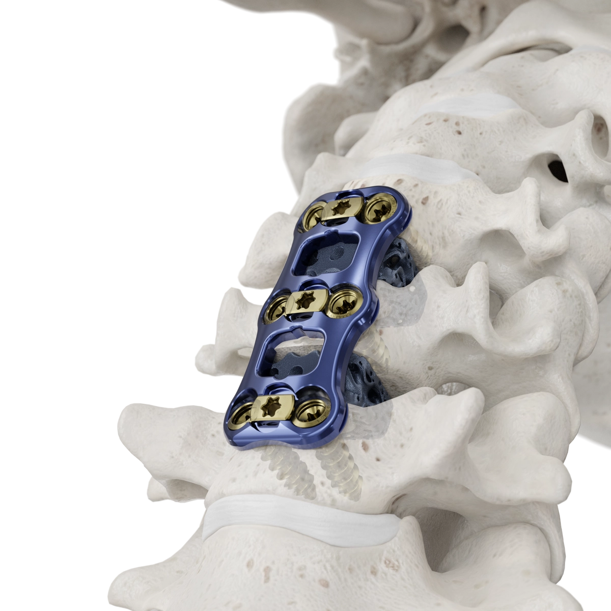 Admiral™ ACP | SeaSpine.com