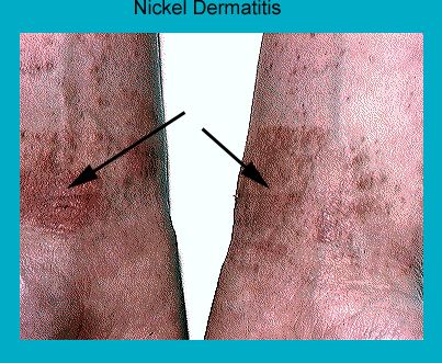 Allergic contact dermatitis – Primary Care Notebook