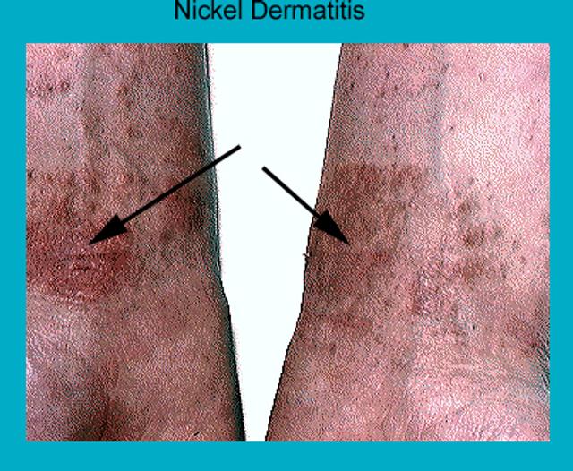 Allergic contact dermatitis – GPnotebook