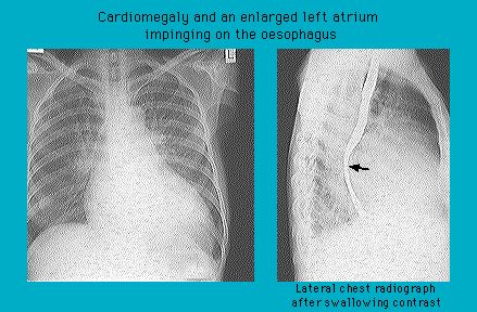 Contrast radiograph showing enlarged left atrium – Primary Care Notebook