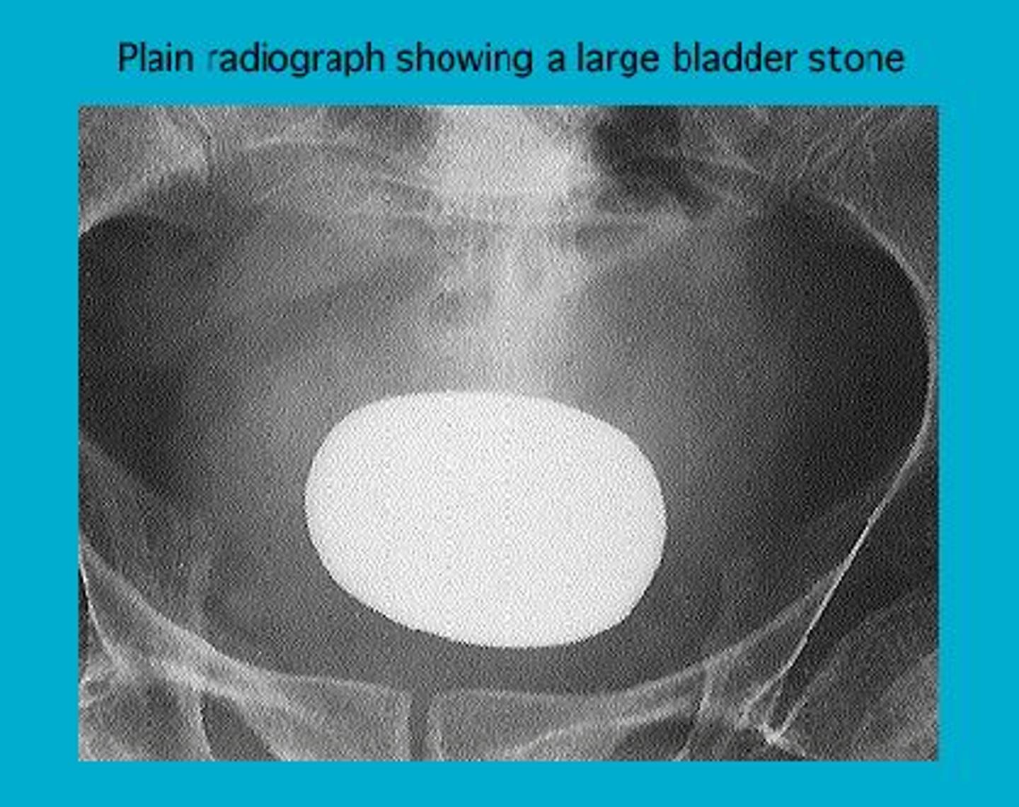 Radiograph showing bladder stone – Primary Care Notebook
