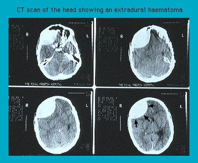 CT scan of an extradural haematoma – GPnotebook