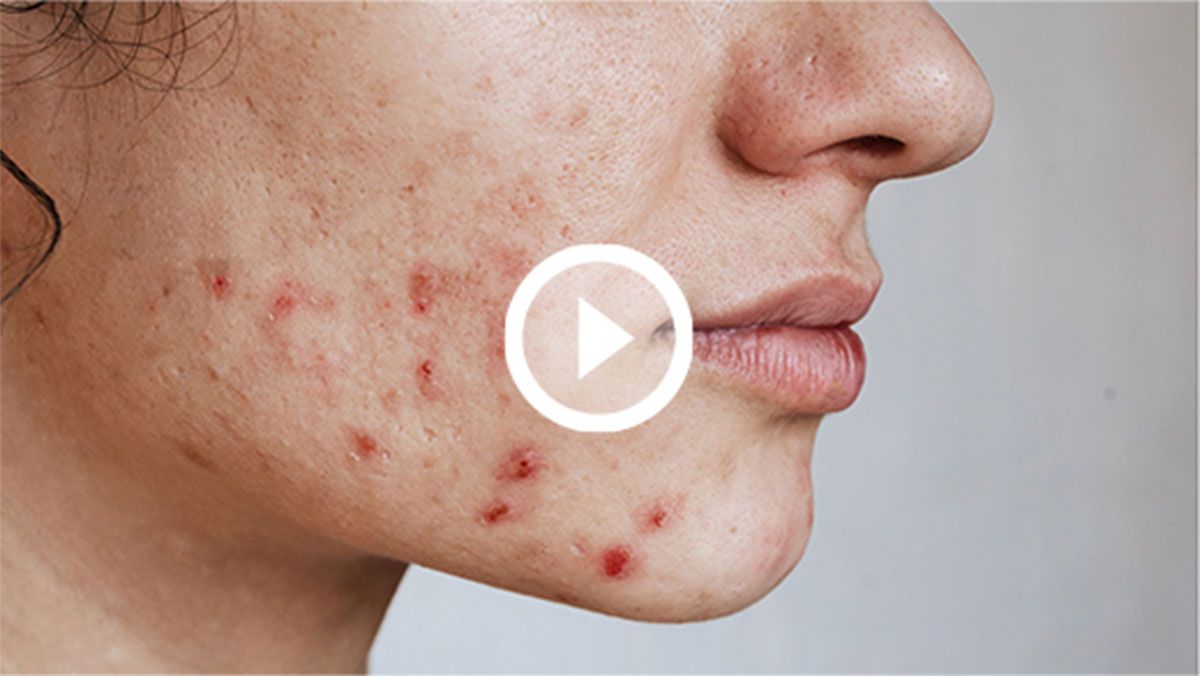 Diagnosis and management of acne – GPnotebook