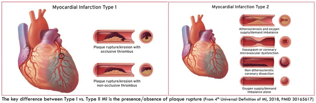 Universal classification of myocardial infarction (MI) – GPnotebook