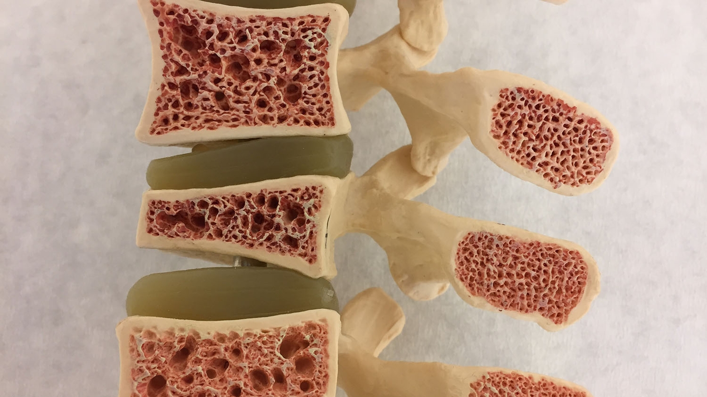 Use of the fracture risk assessment tool (FRAX) in osteoporosis ...