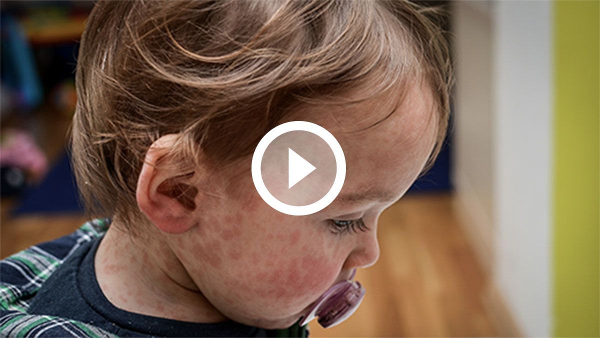 Childhood rashes: viral exanthems – GPnotebook