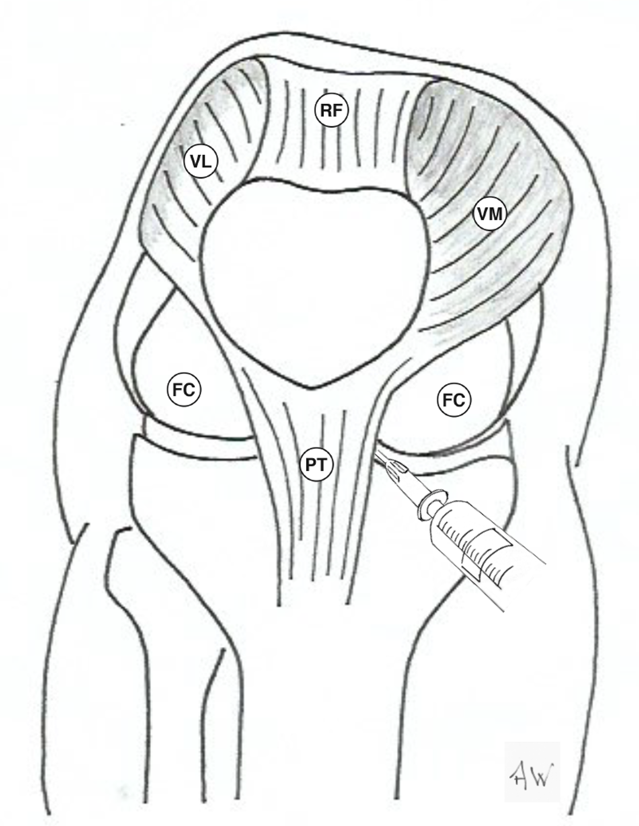 Anterior approach - aspiration or injection of the knee joint ...