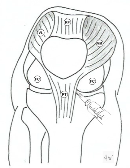 Anterior approach - aspiration or injection of the knee joint – GPnotebook