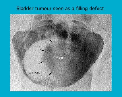 Contrast radiograph showing a bladder tumour – GPnotebook