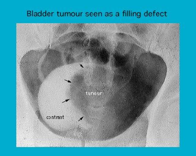 Contrast radiograph showing a bladder tumour – Primary Care Notebook