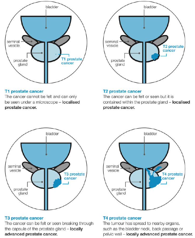 Schéma de la stadification du cancer de la prostate – GPnotebook