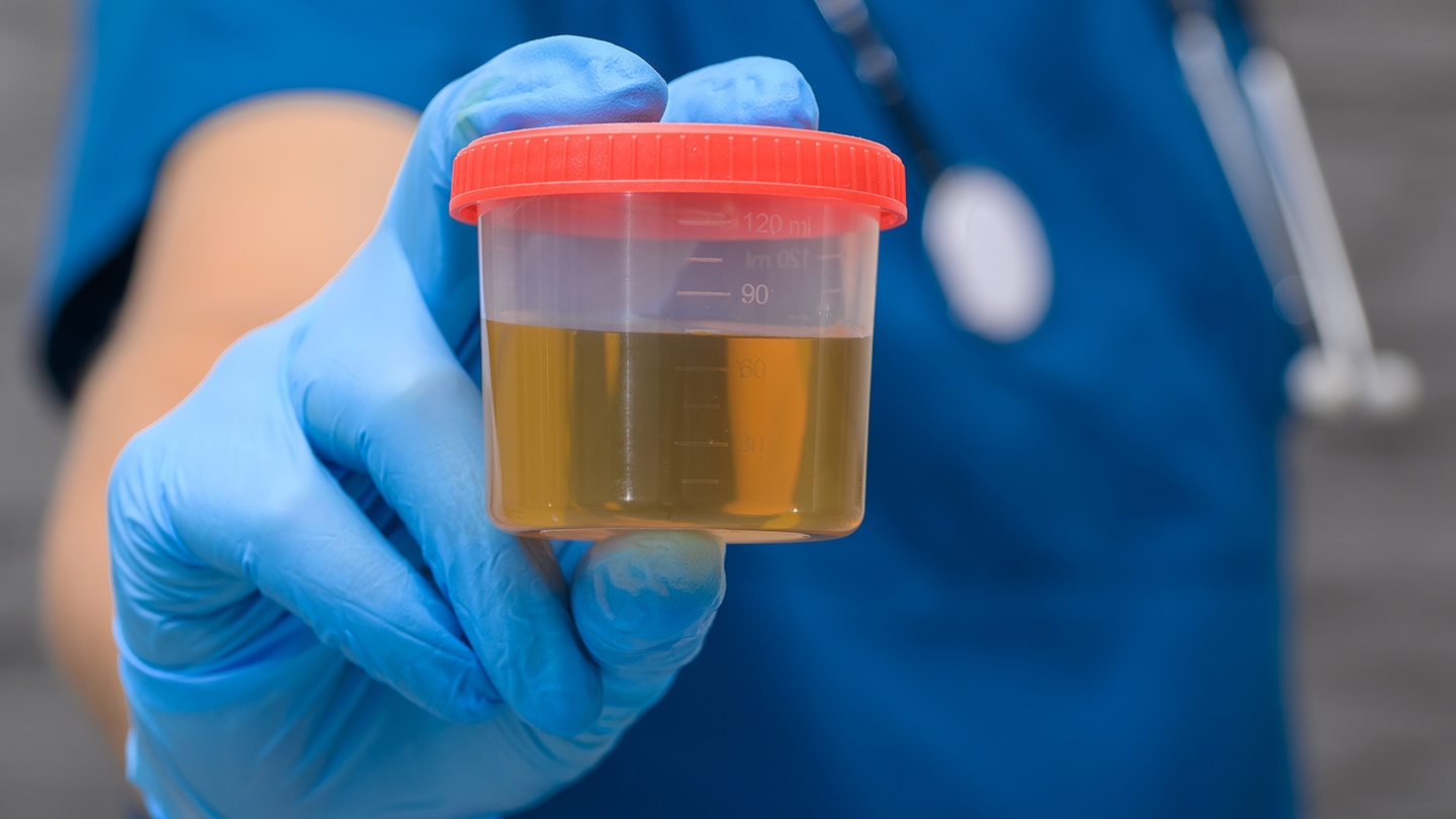 Recurrent urinary tract infections – GPnotebook