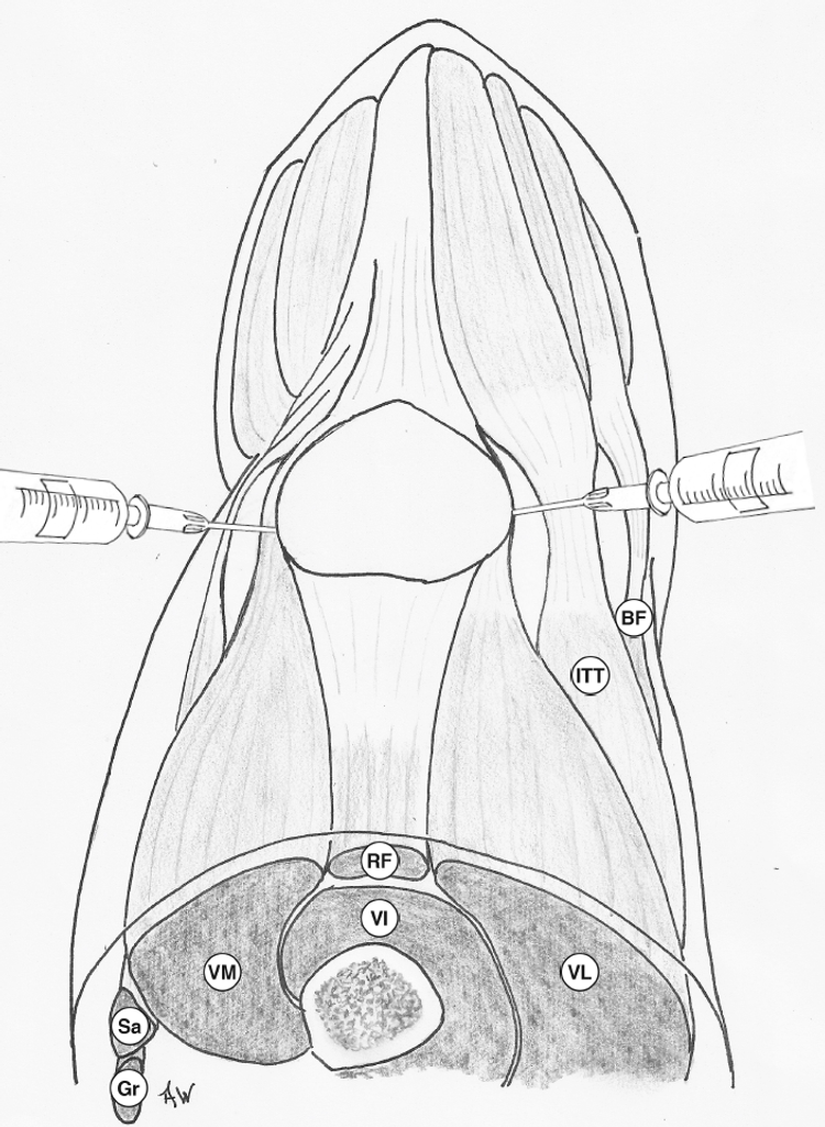 Aspiration or injection of the knee joint – Primary Care Notebook