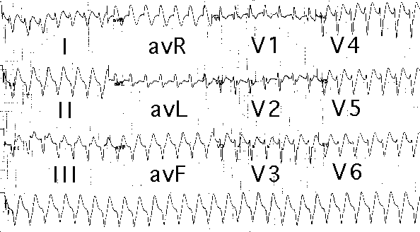 Right bundle branch block (rate related) – GPnotebook