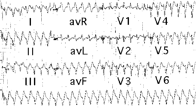 Right bundle branch block (rate related) – Primary Care Notebook