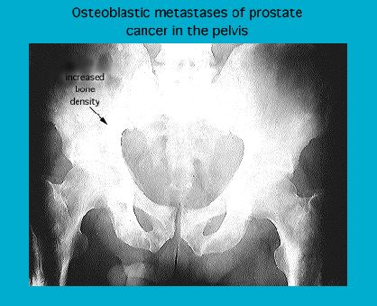 Radiograph showing bone metastases from prostate cancer – GPnotebook
