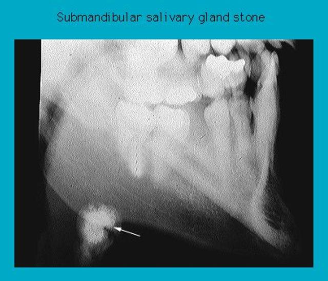 Radiograph showing a submandibular calculus – GPnotebook