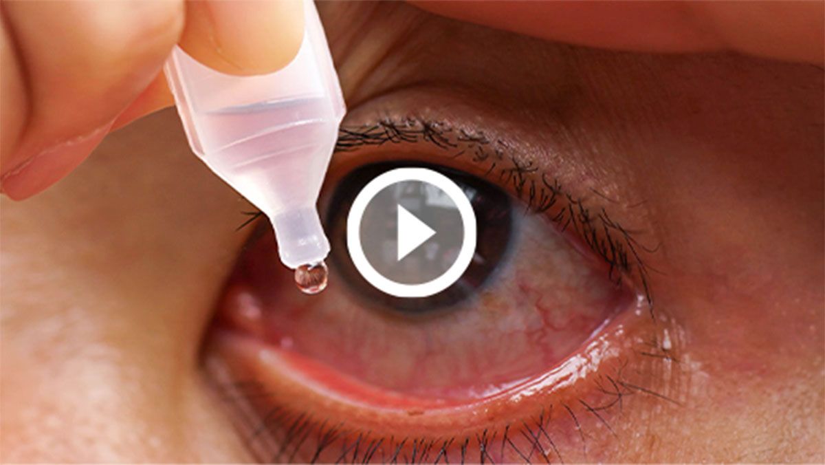 Dry eye – GPnotebook