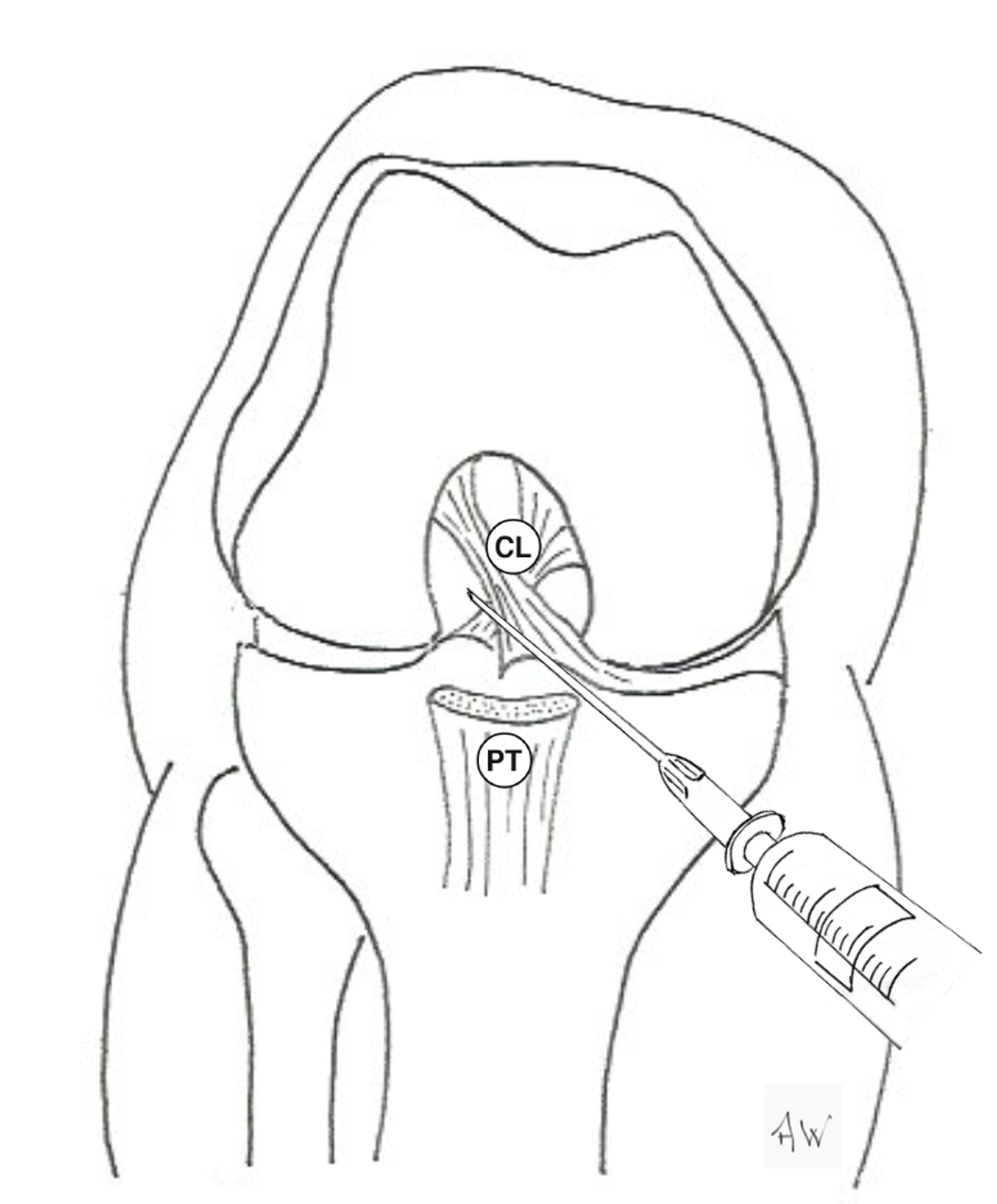 Anterior approach - aspiration or injection of the knee joint – GPnotebook
