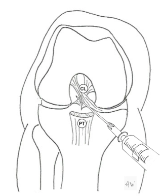 Anterior approach - aspiration or injection of the knee joint ...