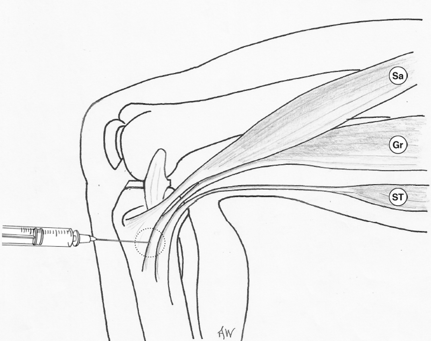 Injection or aspiration of pes anserine bursa – GPnotebook - GPNotebook