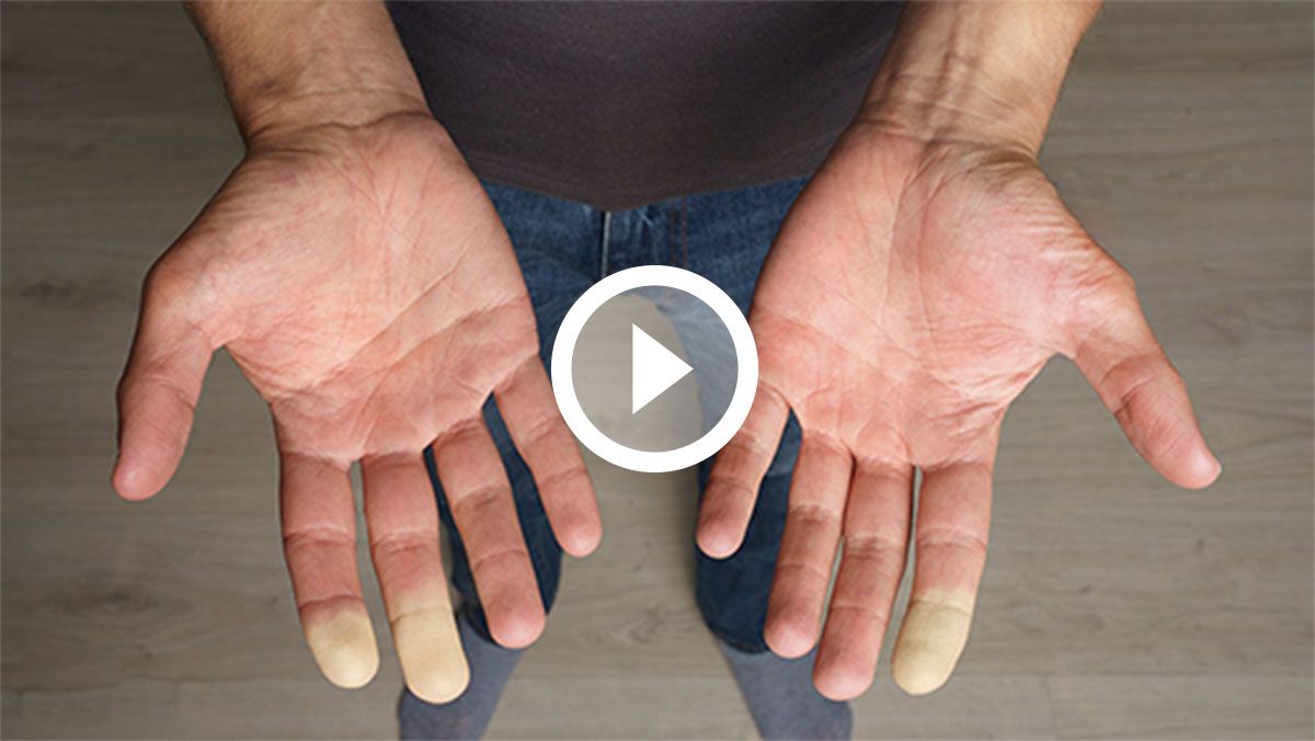 Ep 149 – Raynaud’s phenomenon – GPnotebook