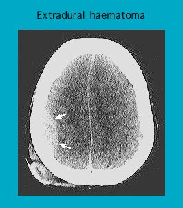 CT scan showing a parietal extradural haematoma – GPnotebook