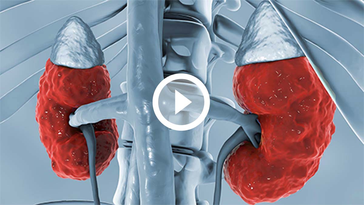Chronic kidney disease risk assessment, referral criteria and ...