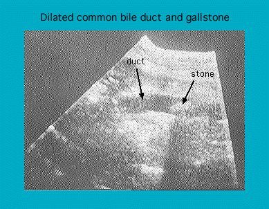 Ultrasound showing dilated CBD and gallstones – GPnotebook