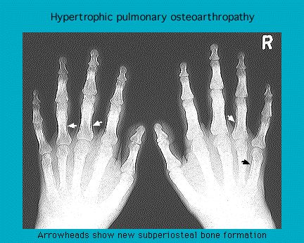 Radiograph showing HPOA – GPnotebook