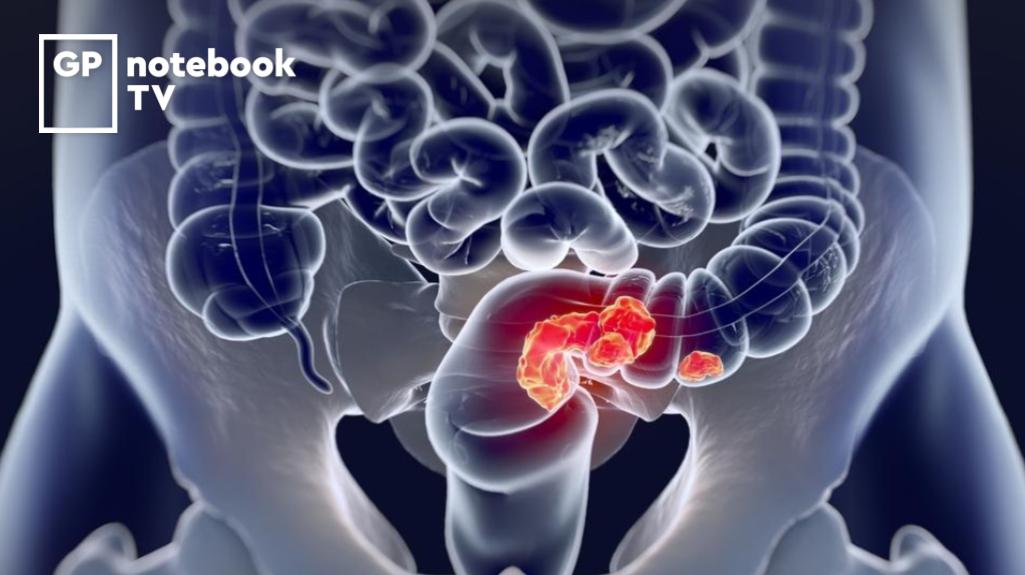 Faecal immunochemical test (FIT) in the detection of bowel cancer